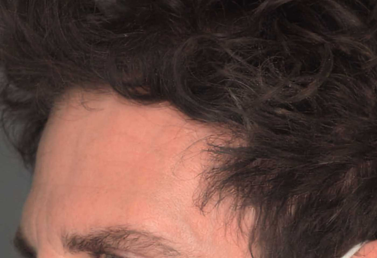 Red Laser Diode Cap for Hair Growth & Hair Loss Stop | KeraFactor