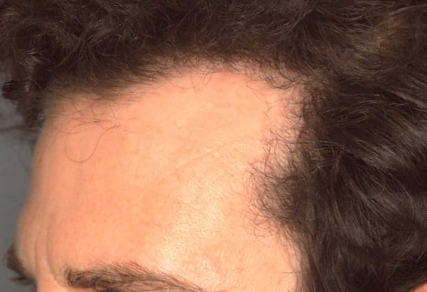Red Laser Diode Cap for Hair Growth & Hair Loss Stop | KeraFactor